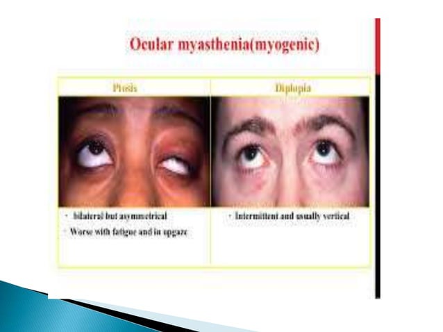 Ptosis eyelid disorders | PPTX