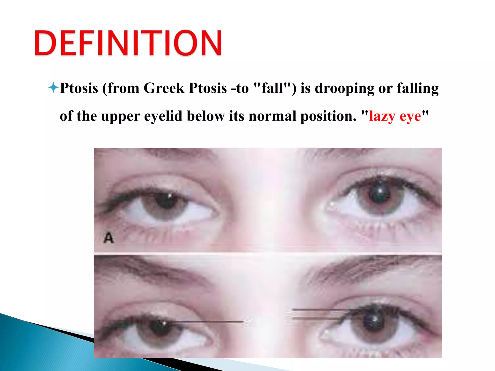 Ptosis | PPTX