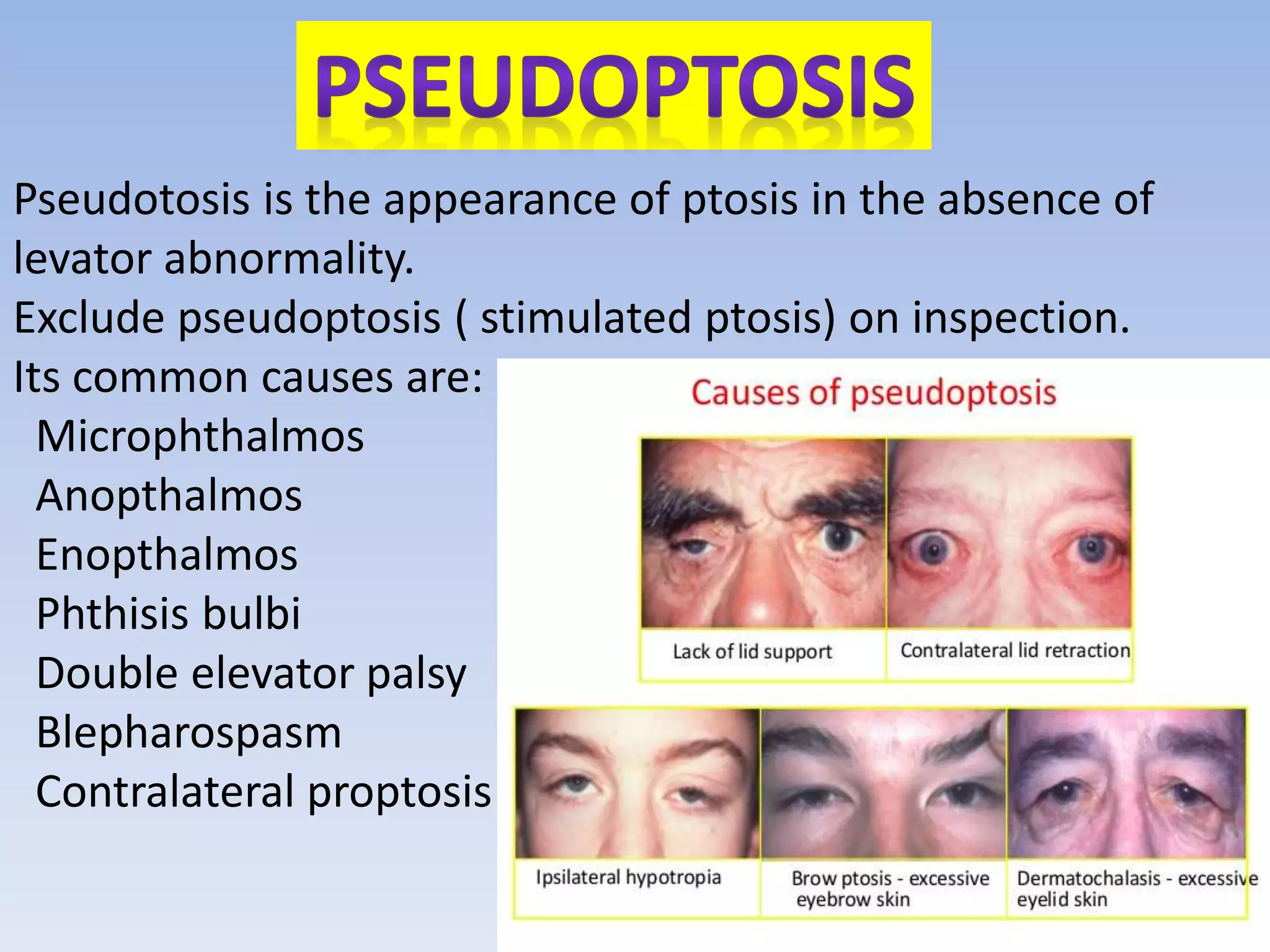 Ptosis | PPTX