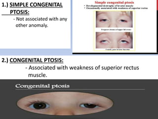 Severe Congenital Ptosis