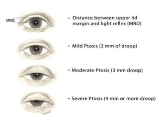 Ptosis | PPTX