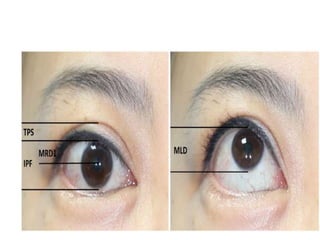 Ptosis | PPTX