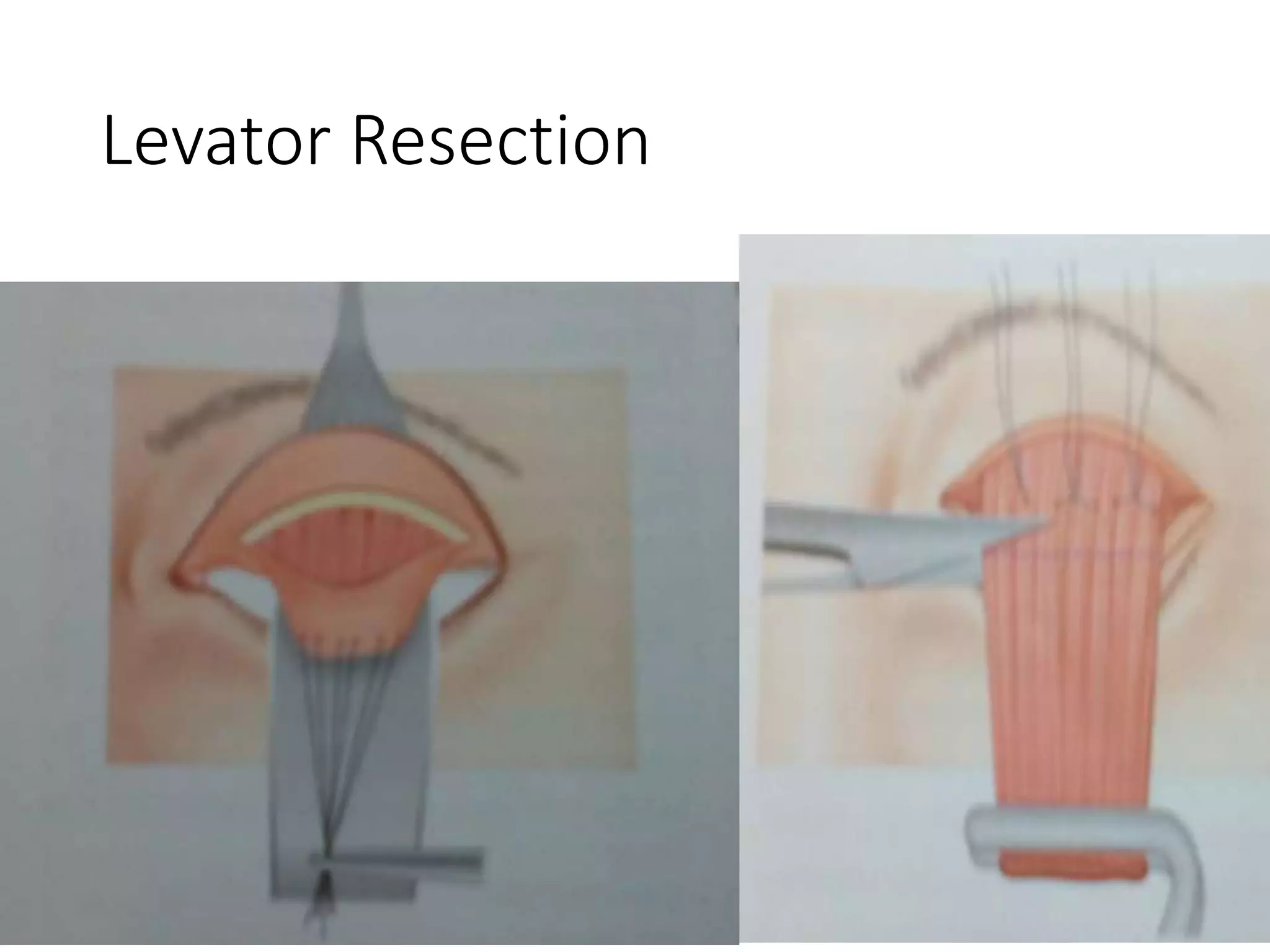 Ptosis | PPTX | Eye and Vision Conditions | Diseases and Conditions