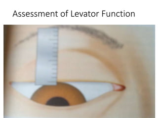Ptosis | PPTX | Eye and Vision Conditions | Diseases and Conditions