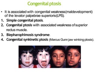 Ptosis | PPT