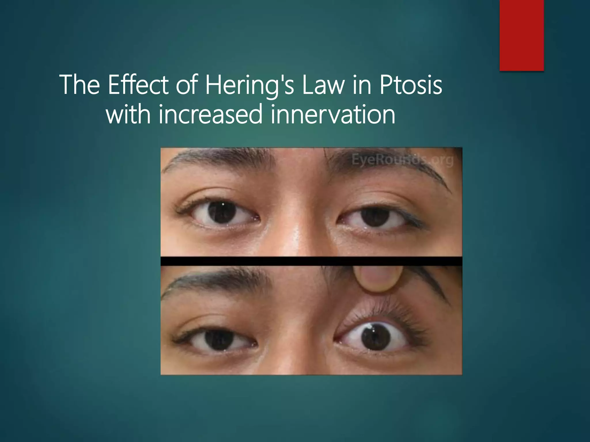 Ptosis | PPTX