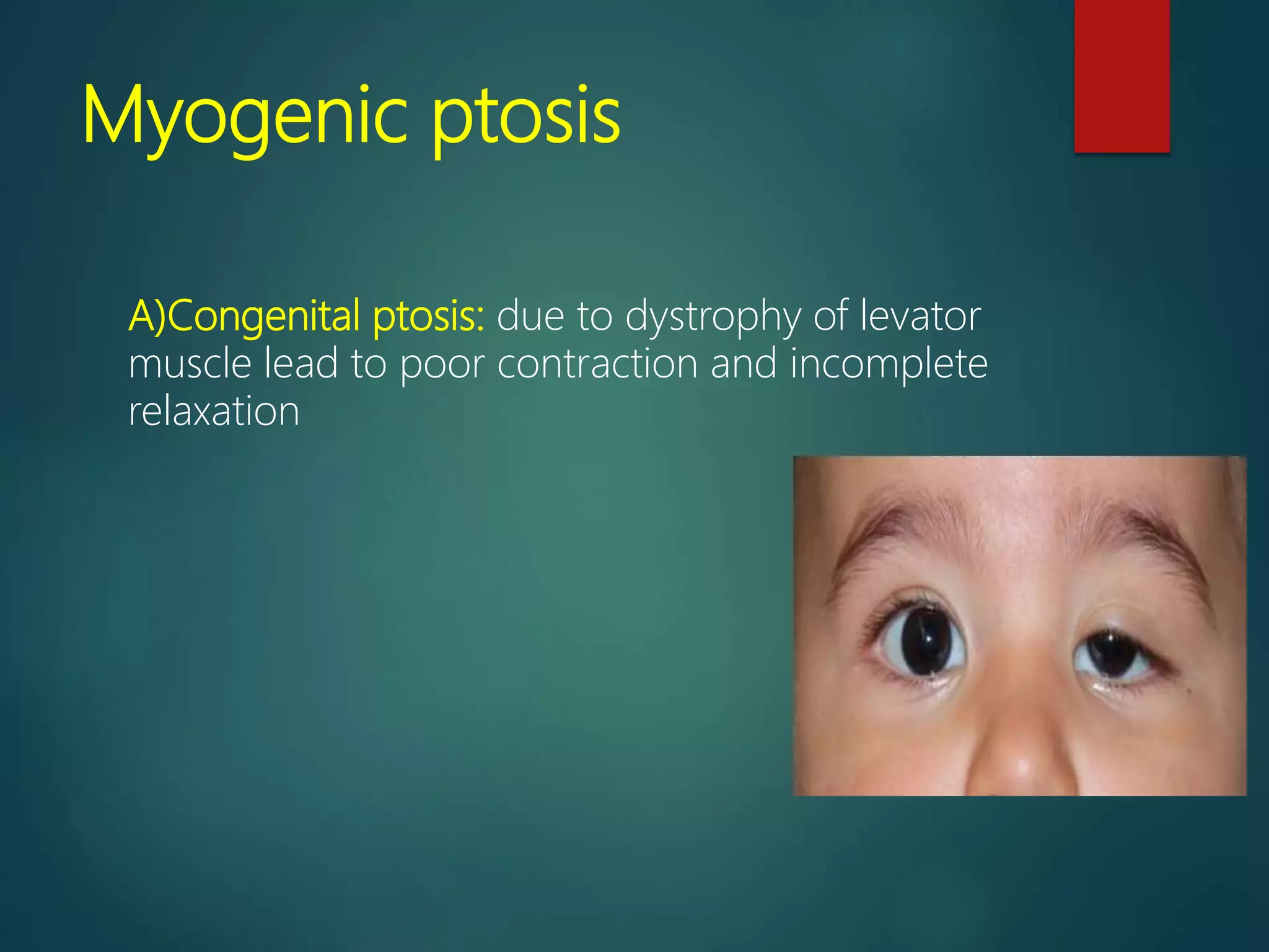 Ptosis | PPTX