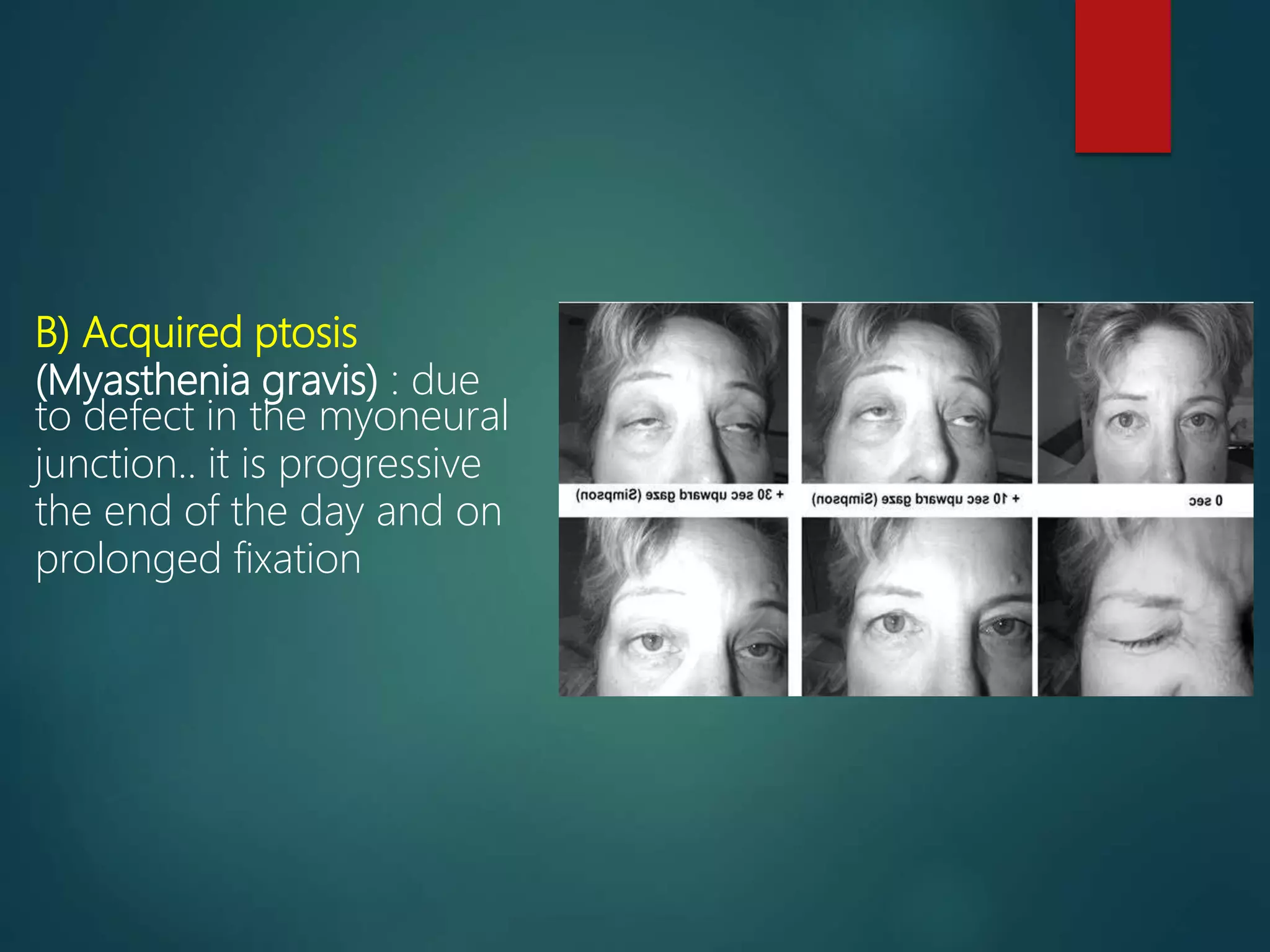 Ptosis | PPTX