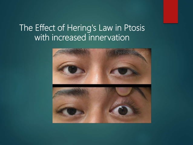 Ptosis | PPTX