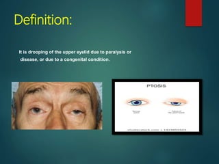 Ptosis | PPTX
