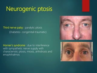 Ptosis | PPTX