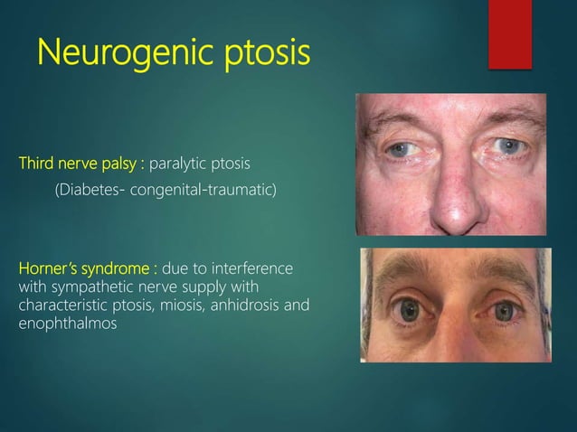 Ptosis | PPTX