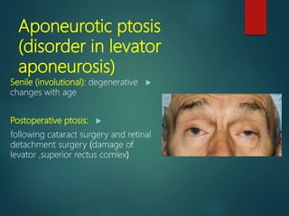 Ptosis | PPTX