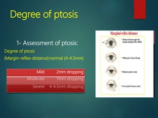 Ptosis | PPTX