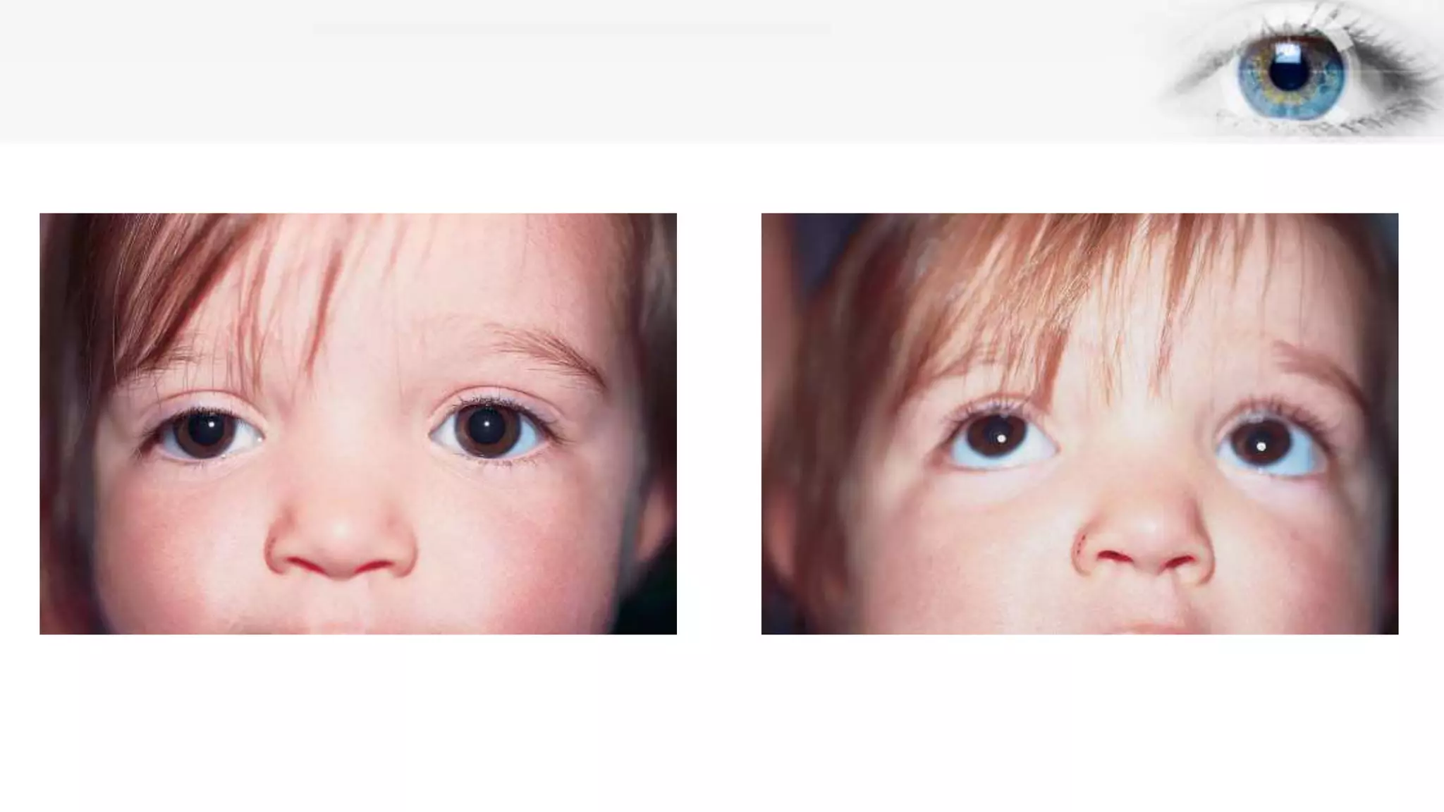 Ptosis: Clinical Anatomy, Diagnosis and Management | PPTX