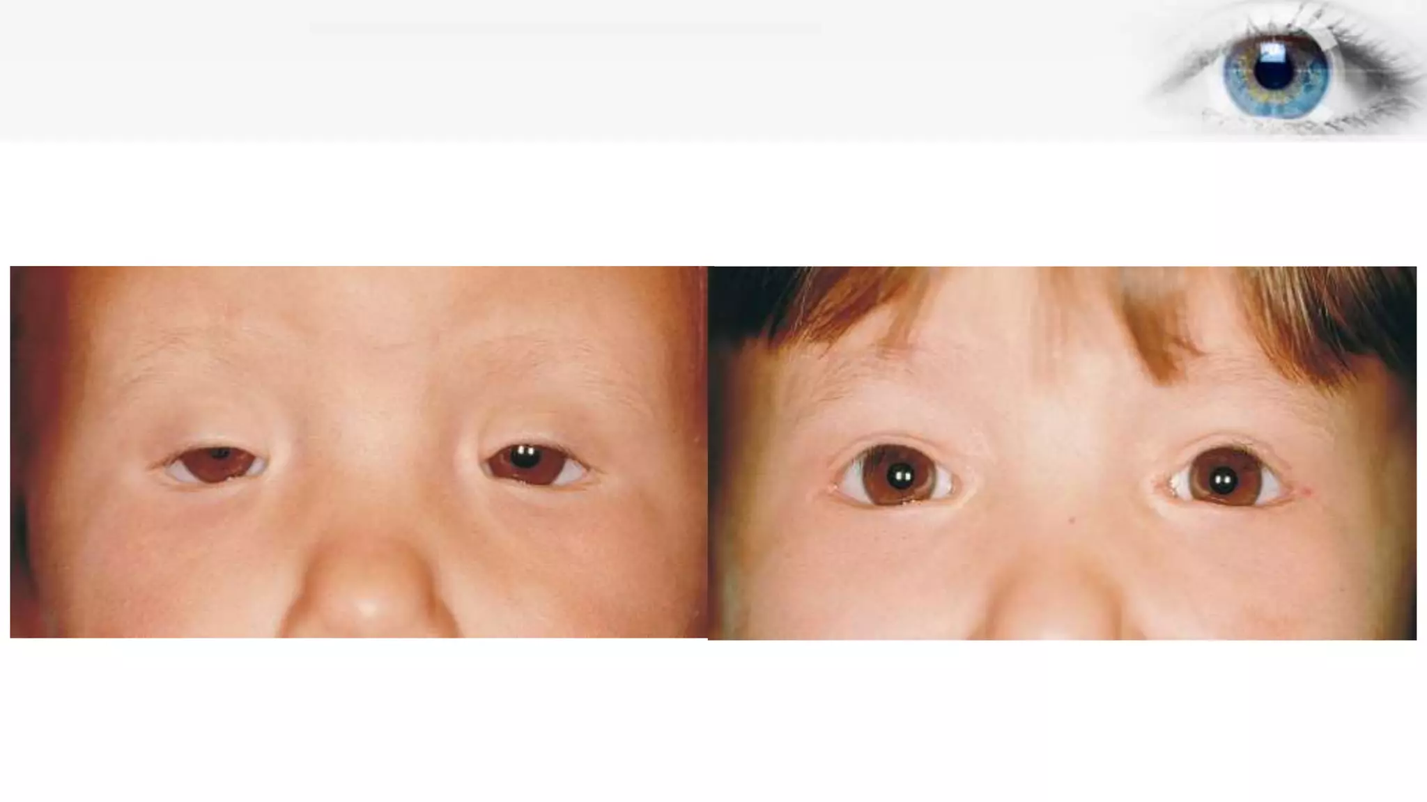 Ptosis: Clinical Anatomy, Diagnosis and Management | PPTX