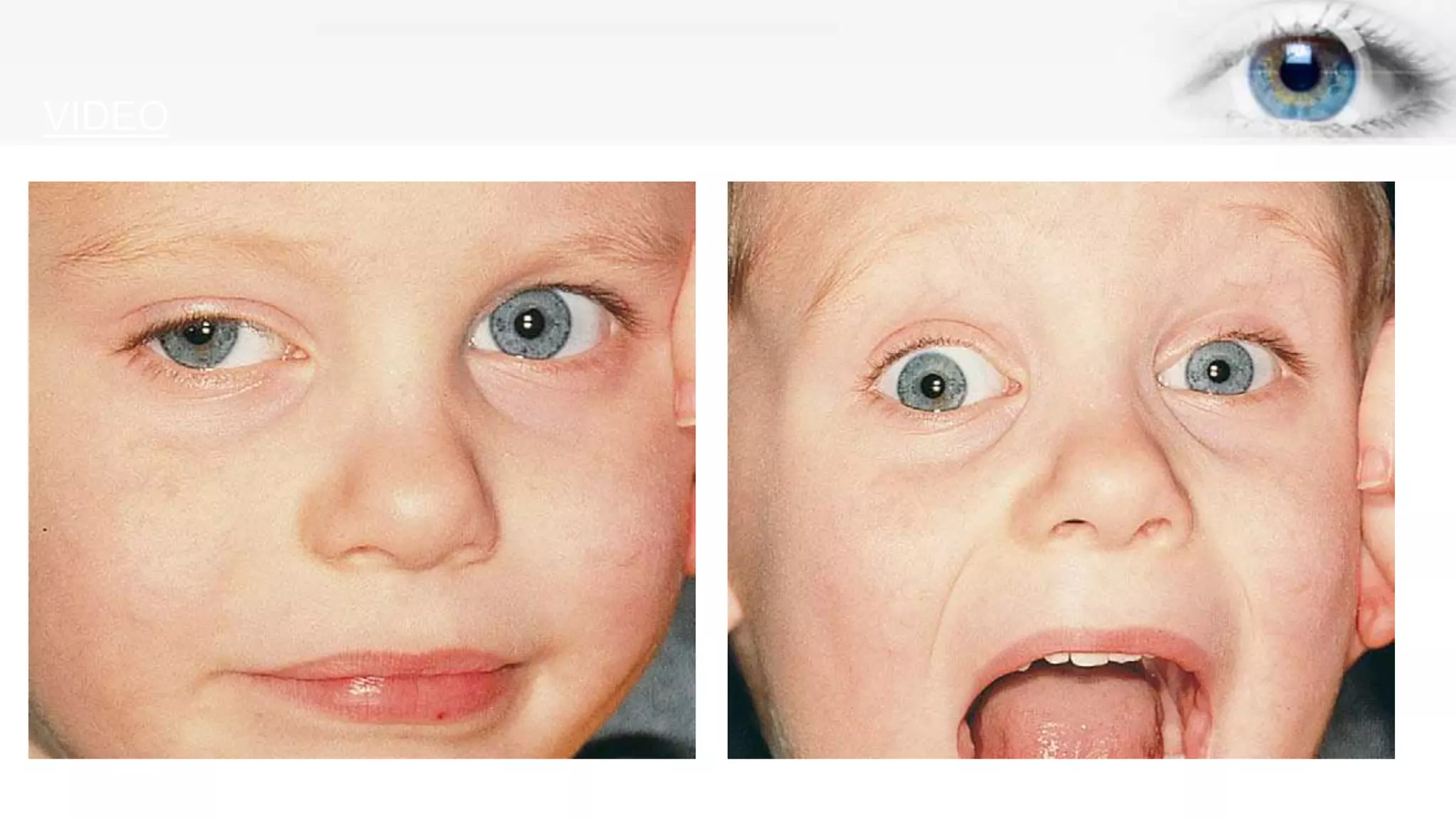 Ptosis: Clinical Anatomy, Diagnosis and Management | PPTX