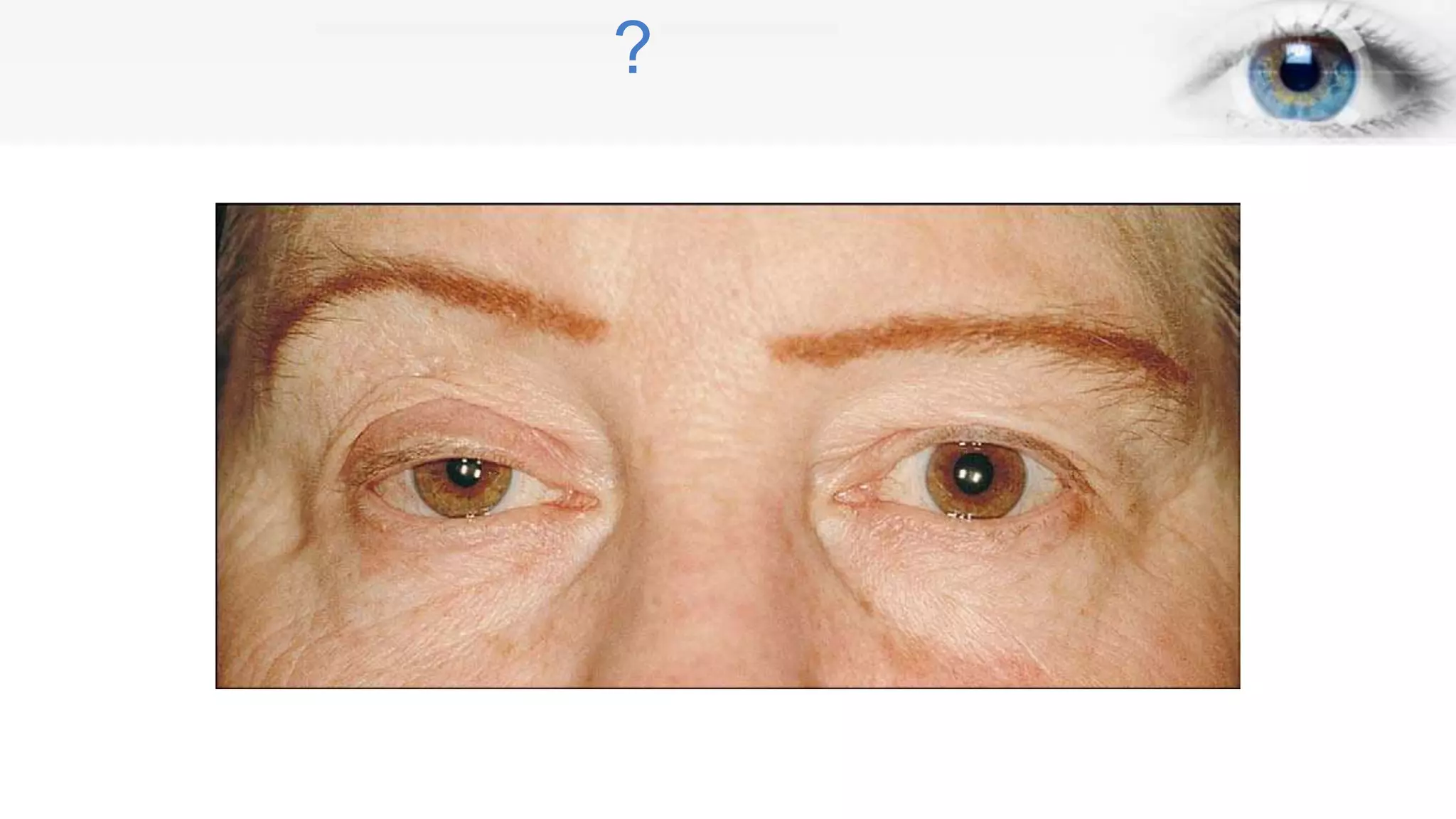 Ptosis: Clinical Anatomy, Diagnosis and Management | PPTX