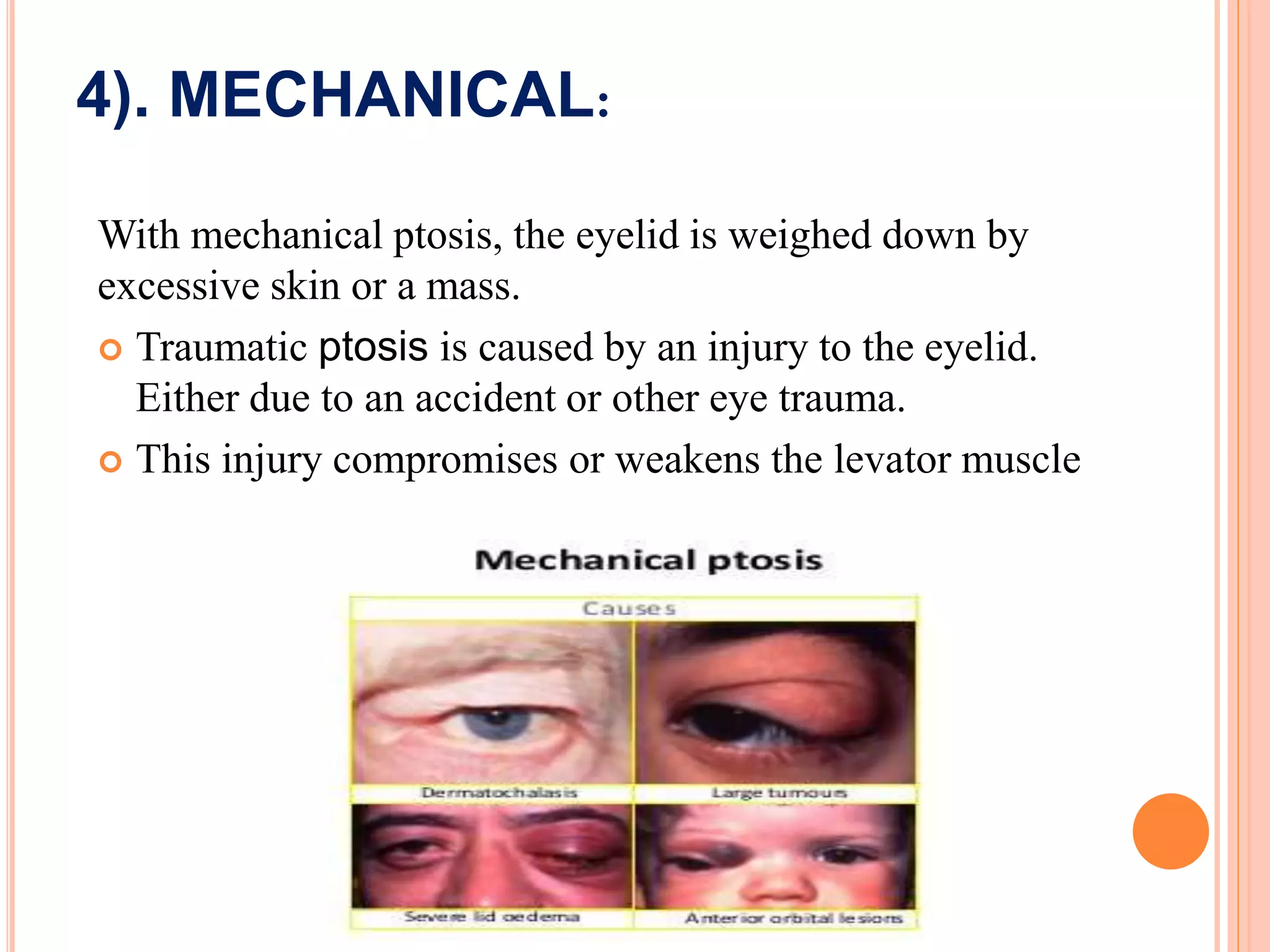 PTOSIS.pptx
