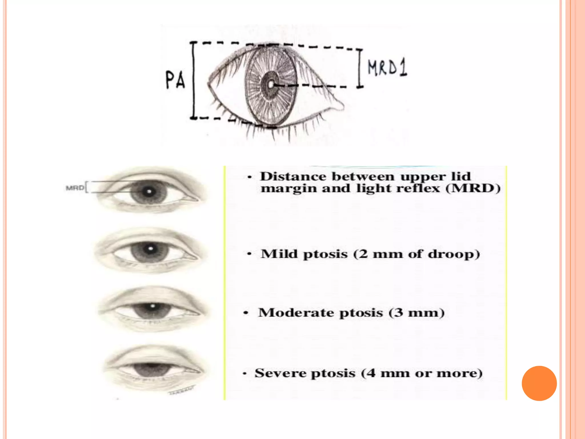 PTOSIS.pptx | Eye and Vision Conditions | Diseases and Conditions