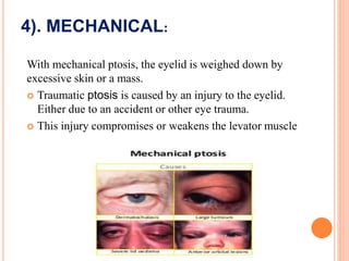 PTOSIS.pptx