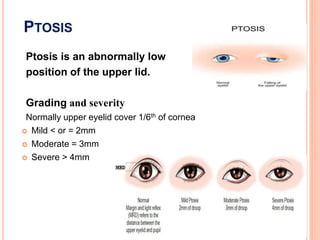 PTOSIS.pptx | Eye and Vision Conditions | Diseases and Conditions