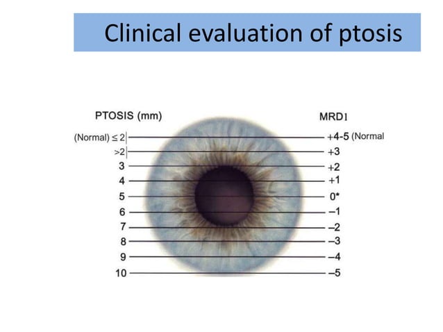 ptosis.pptx | Free Download