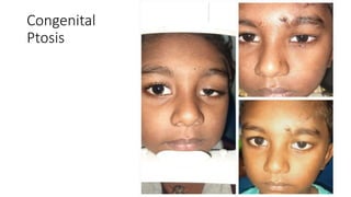 Ptosis.pptx