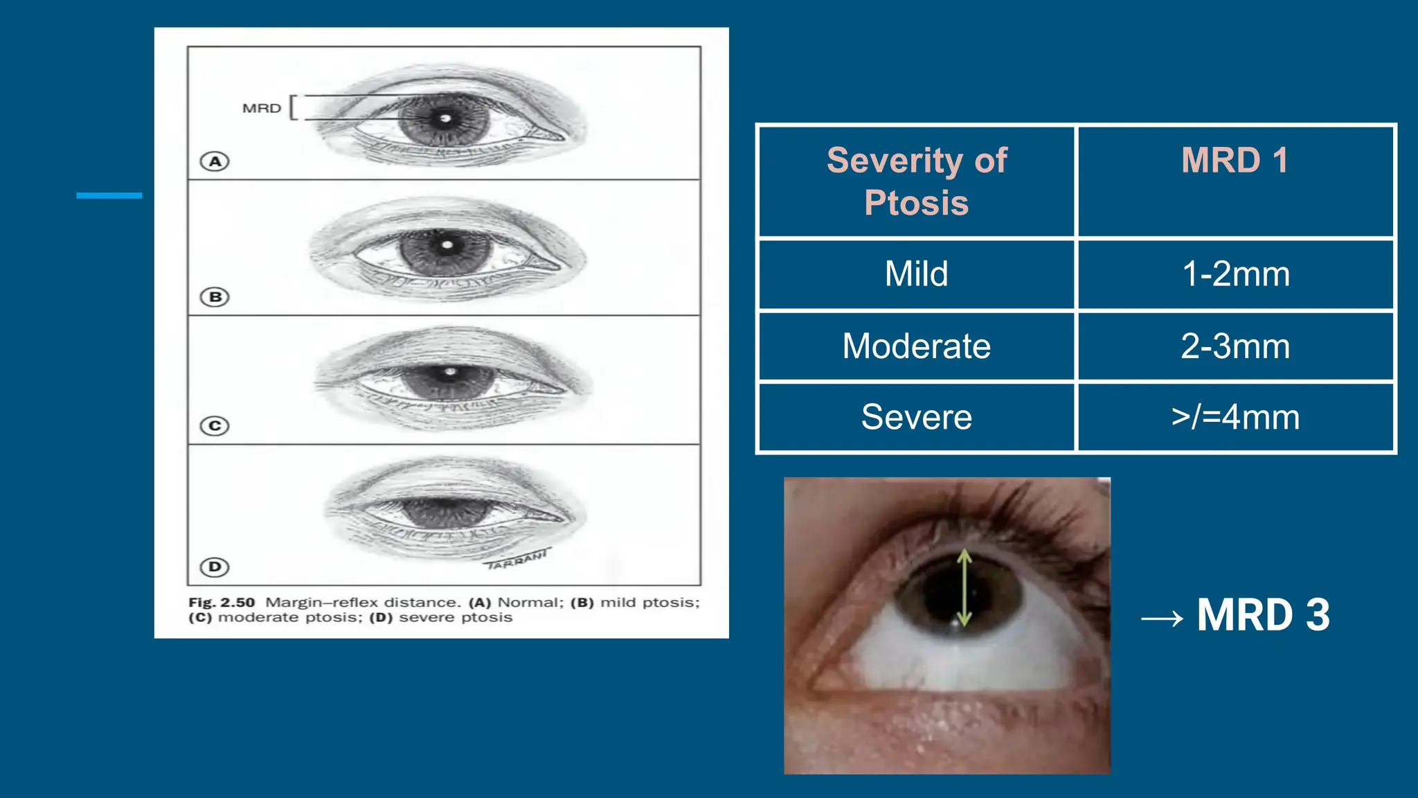 PTOSIS OF UPPER LID AND MANAGEMENT OF PTOSIS | PDF
