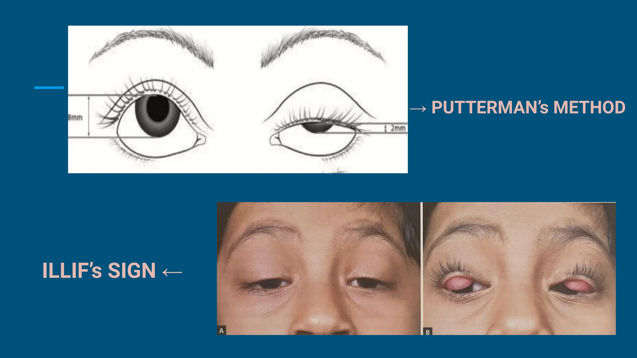 PTOSIS OF UPPER LID AND MANAGEMENT OF PTOSIS | PDF