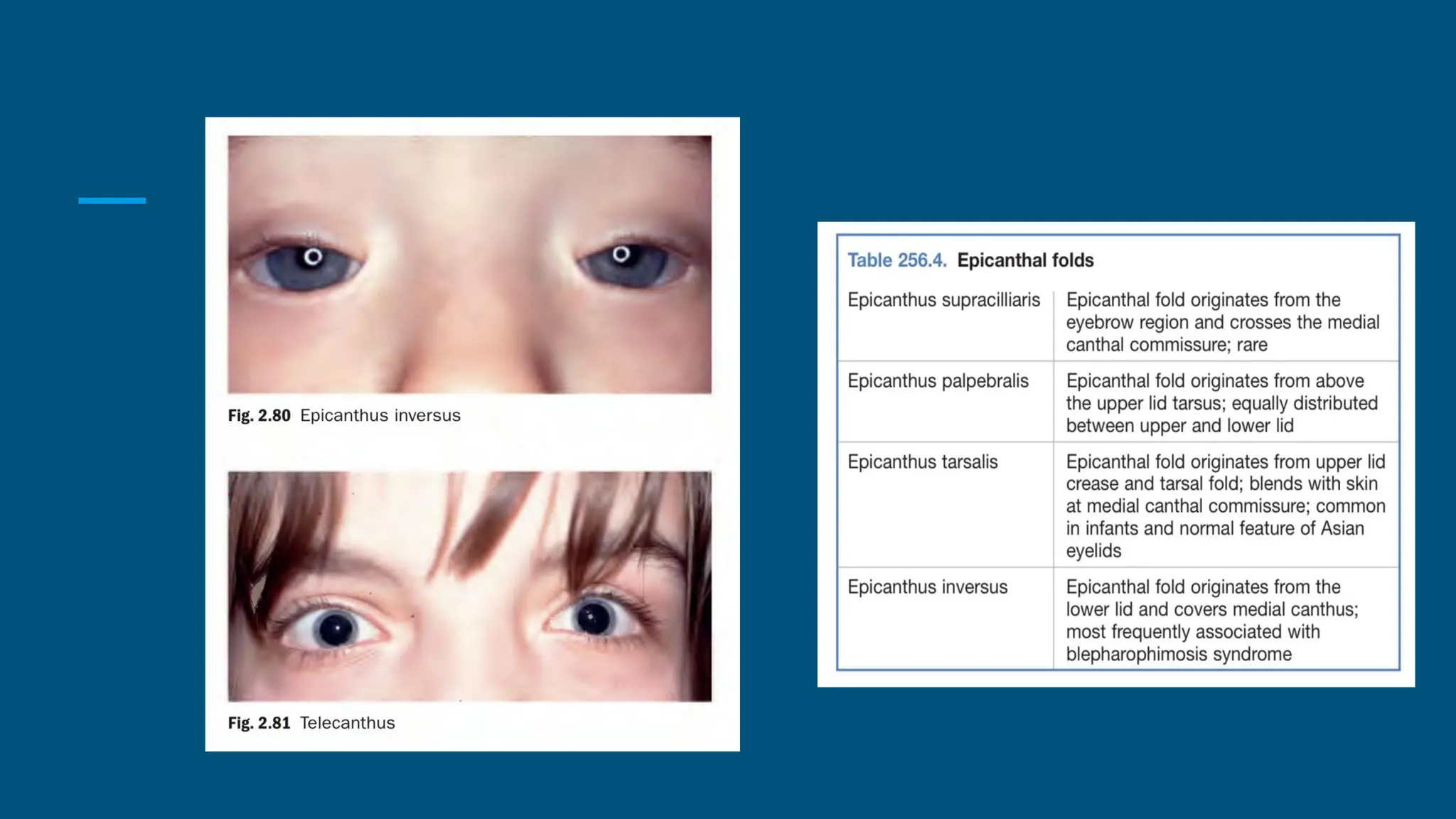 PTOSIS OF UPPER LID AND MANAGEMENT OF PTOSIS | PDF