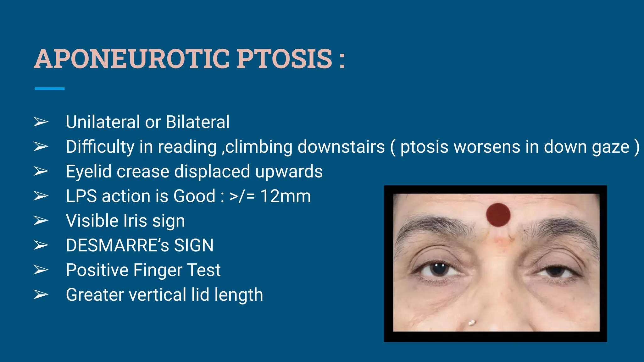 PTOSIS OF UPPER LID AND MANAGEMENT OF PTOSIS | PDF