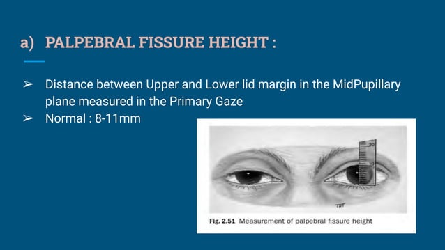 PTOSIS OF UPPER LID AND MANAGEMENT OF PTOSIS | PPT
