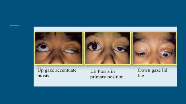 PTOSIS OF UPPER LID AND MANAGEMENT OF PTOSIS | PPT