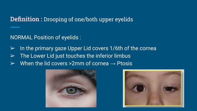 PTOSIS OF UPPER LID AND MANAGEMENT OF PTOSIS | PPT