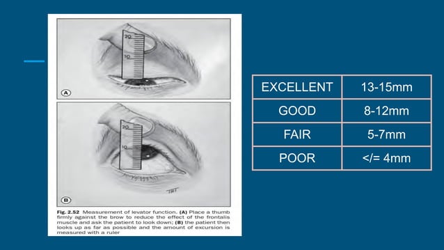 PTOSIS OF UPPER LID AND MANAGEMENT OF PTOSIS | PPT