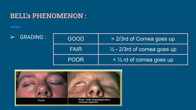 PTOSIS OF UPPER LID AND MANAGEMENT OF PTOSIS | PPT