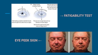 PTOSIS OF UPPER LID AND MANAGEMENT OF PTOSIS | PDF