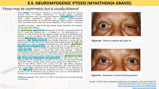 Acquired ptosis (sụp mi mắc phải) 2024_NSP.pptx