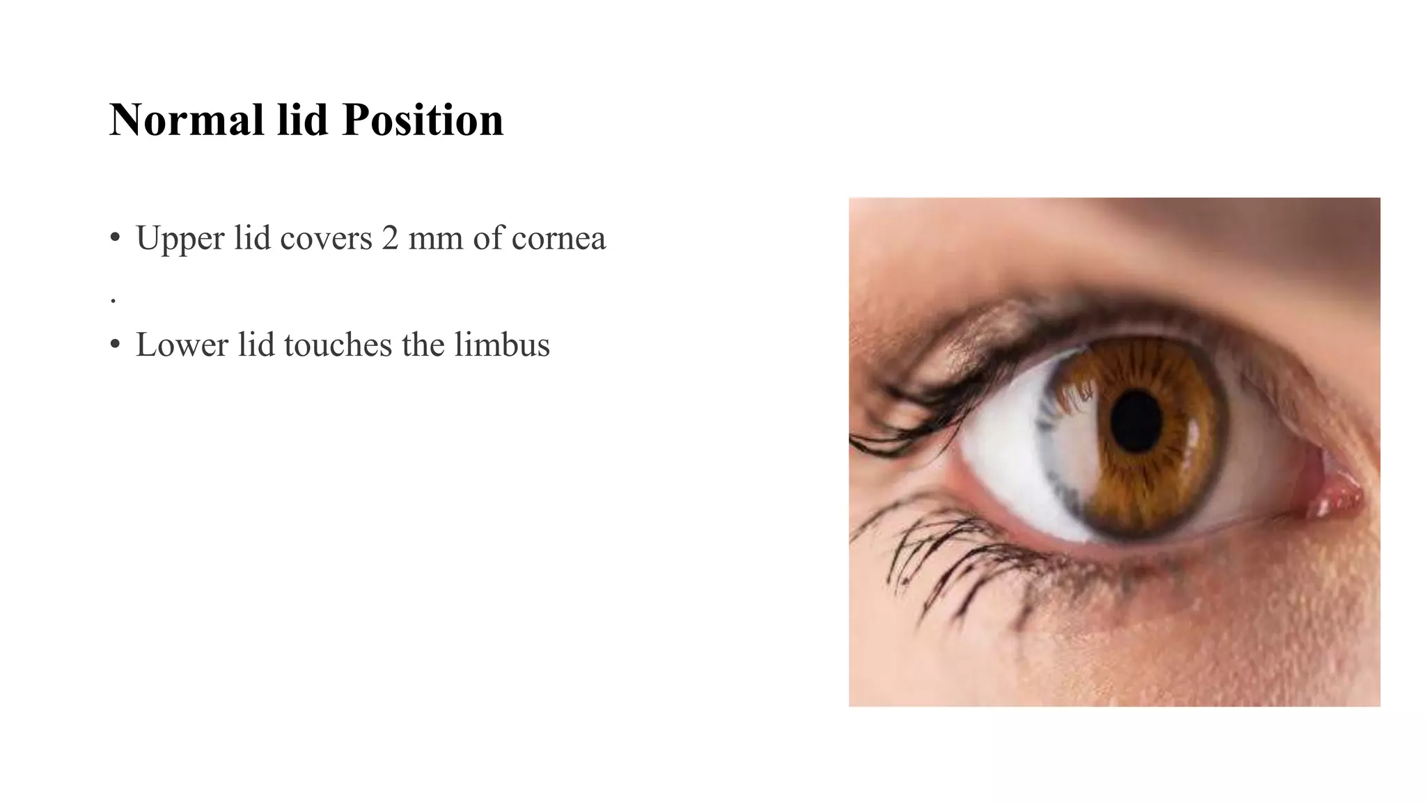 Ptosis.dr Ashfak.pptx