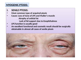 Comprehensive Evaluation and Management of Ptosis in Ophthalmology | PPTX