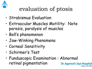 Ptosis - Dr.Divya | PPT