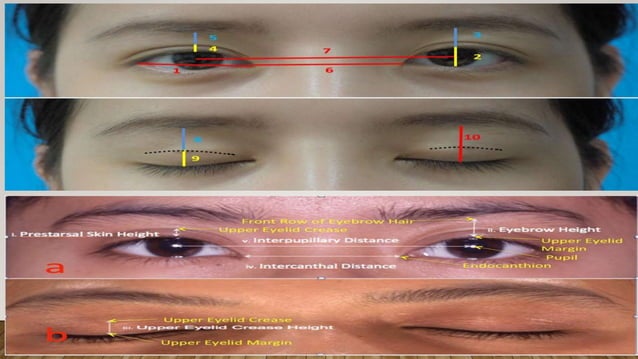Ptosis Evaluation.pptx