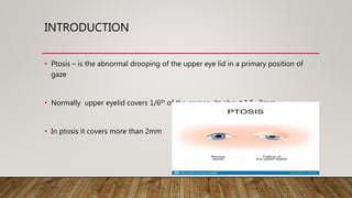 Ptosis Evaluation.pptx