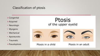 Ptosis Evaluation.pptx