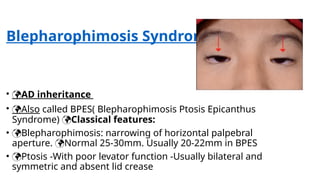 Ptosis Explanation for junior ophthalmoogist.pptx