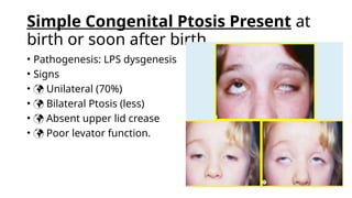 Ptosis Explanation for junior ophthalmoogist.pptx