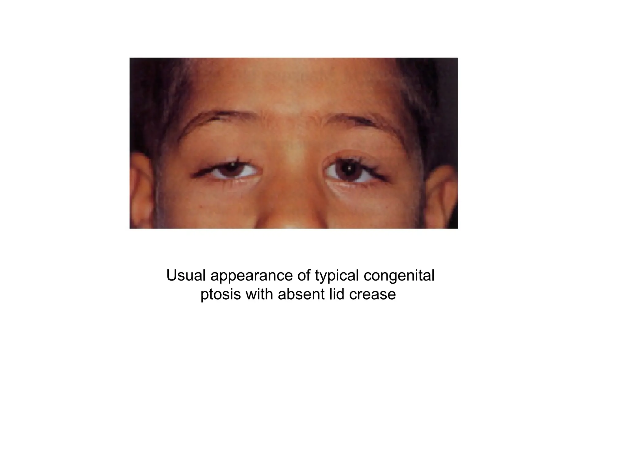 ptosis evaluation and management presentation | PPT