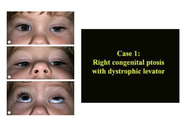 ptosis evaluation and management presentation | PPT