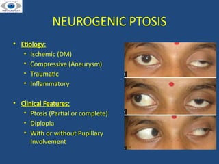 PTOSIS . CLINICAL FEATURES . DIAGNOSIS . MANAGMENT LINES | PPTX